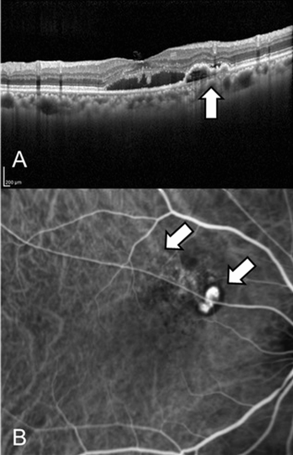 Intraocular Inflammation Following Faricimab Intravitreal Injection ...