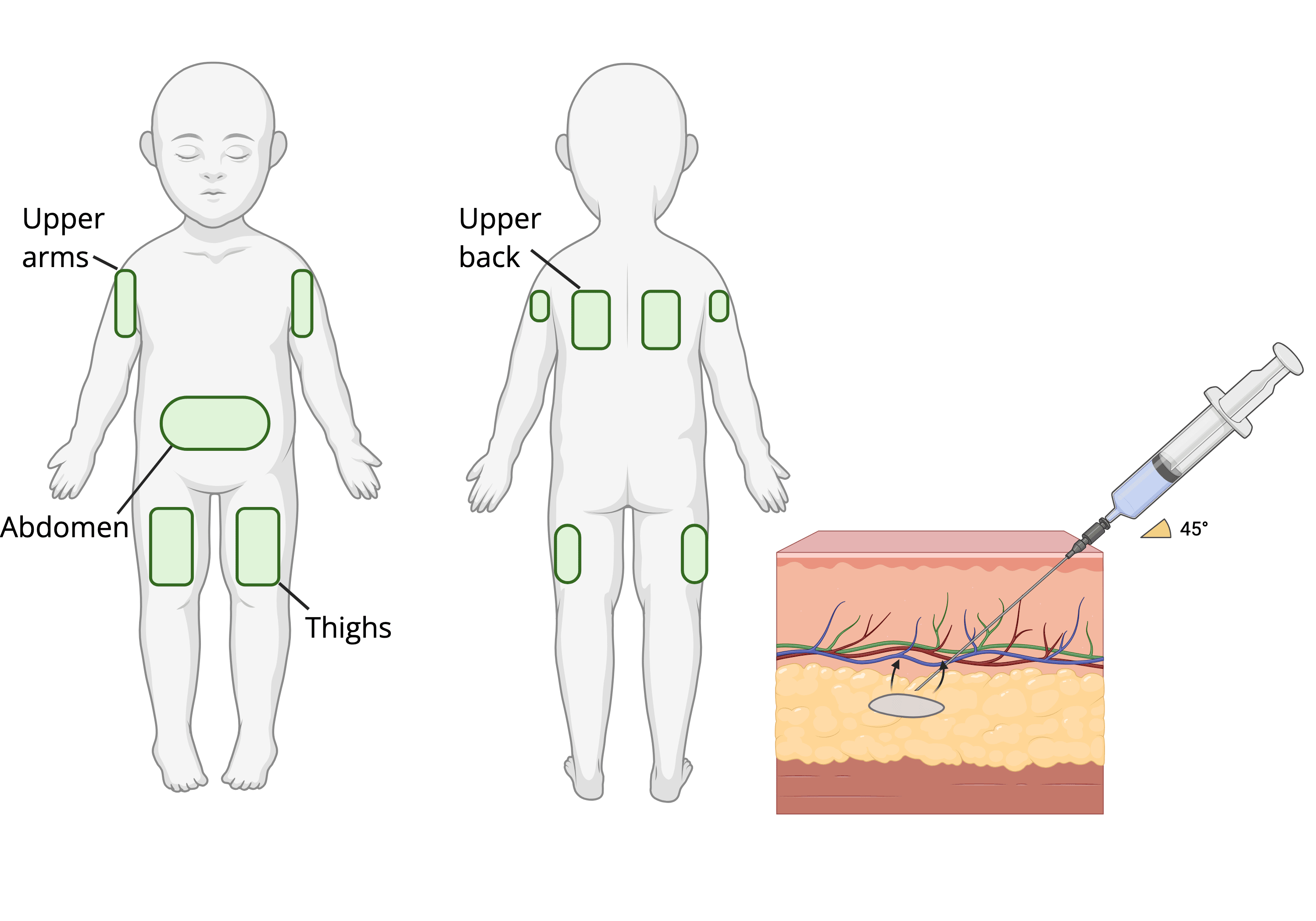 Subcutaneous Fluid Administration in Pediatric Sepsis With Challenging ...