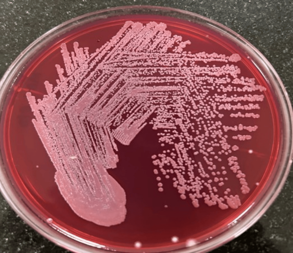 Chronic Osteomyelitis of the Femur: A Rare Manifestation of Melioidosis ...