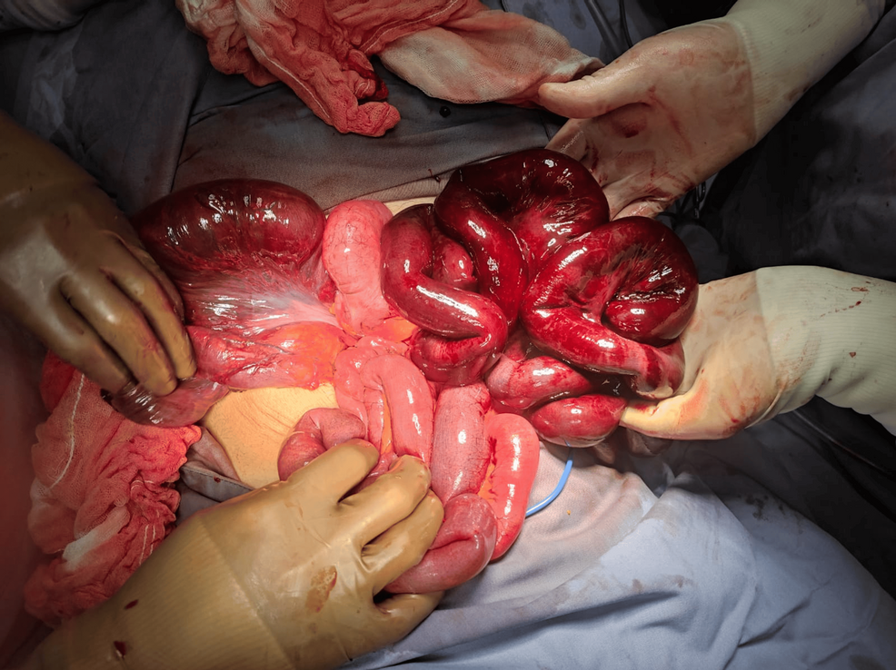 Ileo-Ileal Knotting: A Rare Case of Bowel Strangulation | Cureus