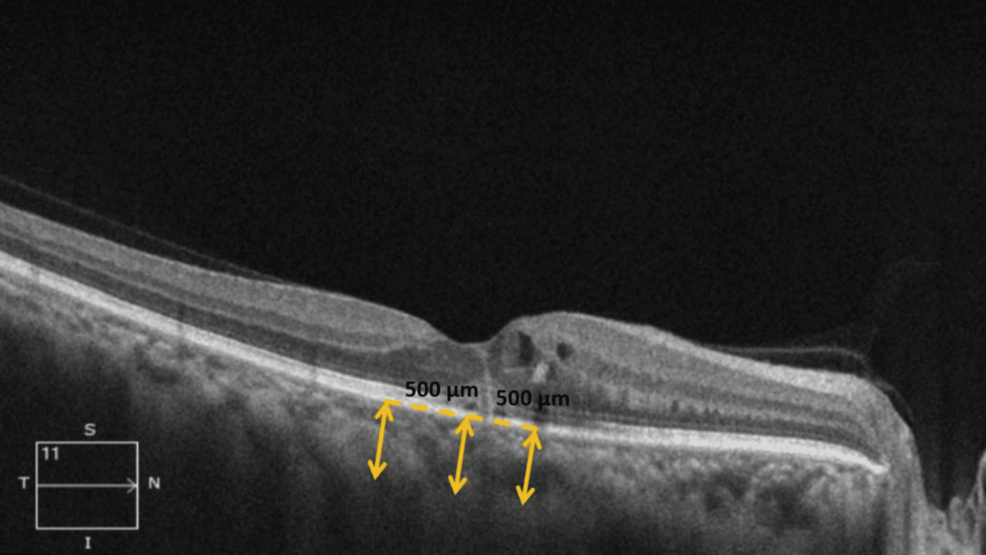 Comparison of Choroidal Thickness in Affected and Fellow Eyes of ...