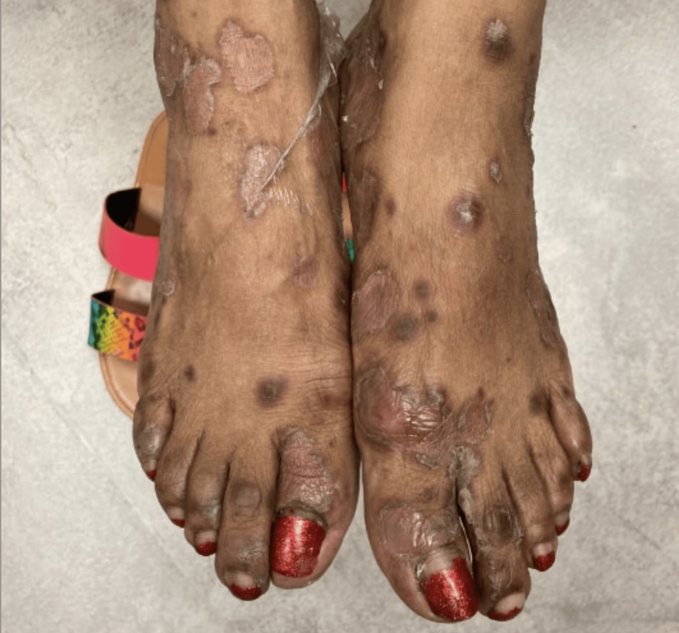 Successful Treatment of Adalimumab-Induced Pustular Psoriasis With ...