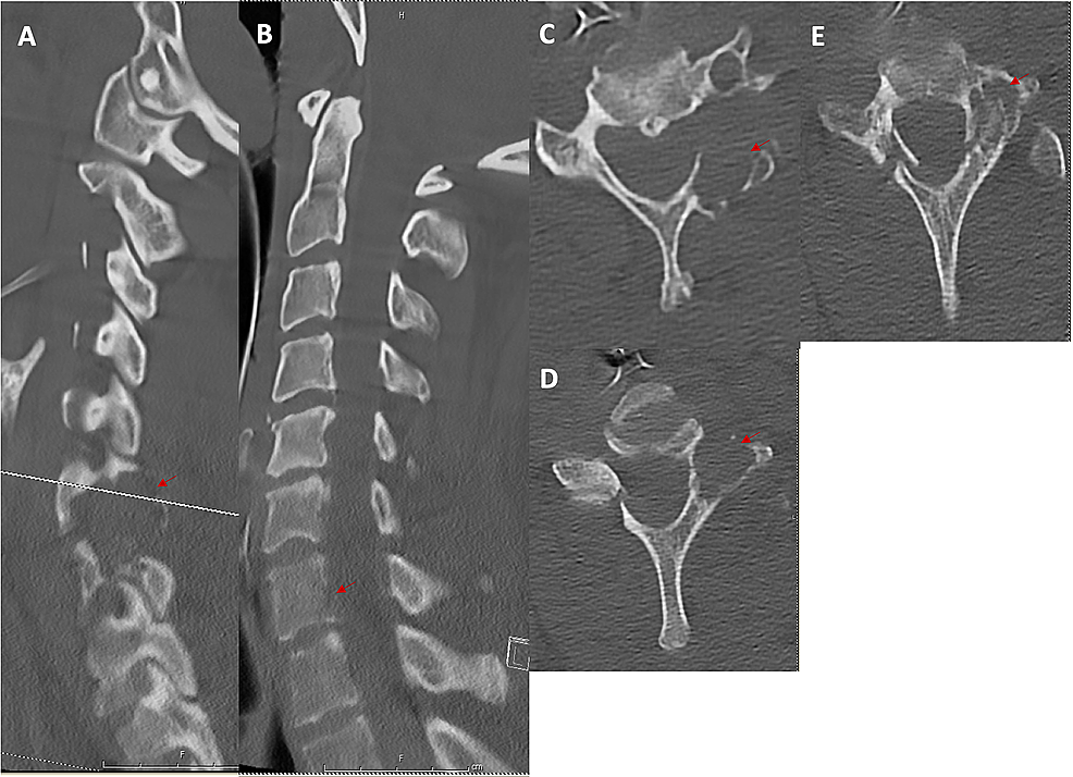 Cureus Tenosynovial Giant Cell Tumor Of The Cervical Spine Case Cureus Tenosynovial Giant Cell Tumor Of The Cervical Spine Case