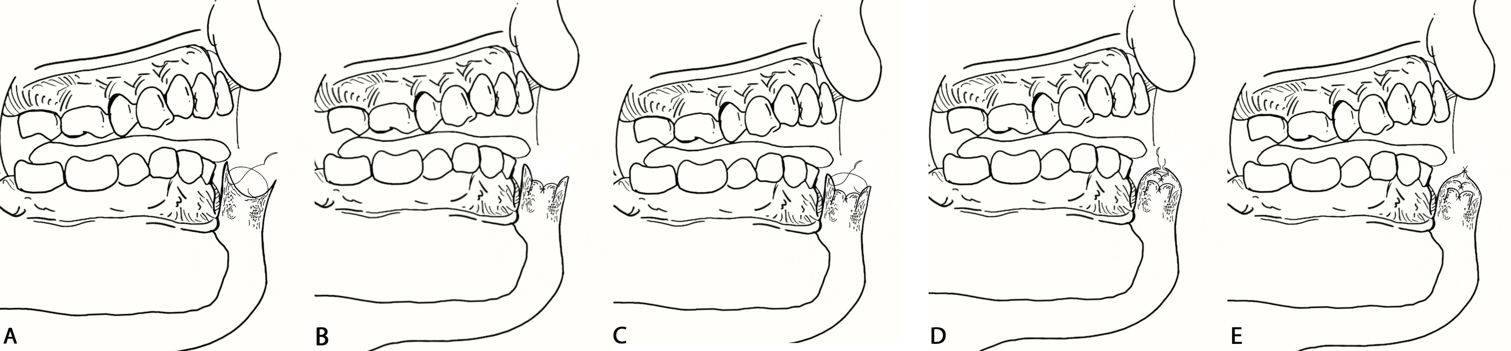 Repair of a Large Vermilion Defect of the Lower Lip Following ...