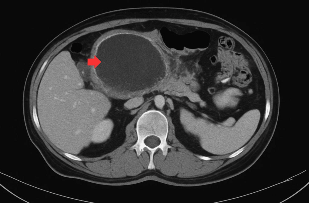 Transparietal Gastric Drainage of Walled-Off Pancreatic Necrosis Using ...