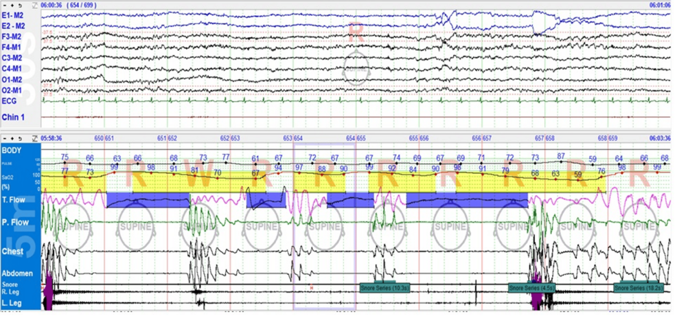Rapid Eye Movement (REM)-Predominant Central Sleep Apnea With Alpha ...