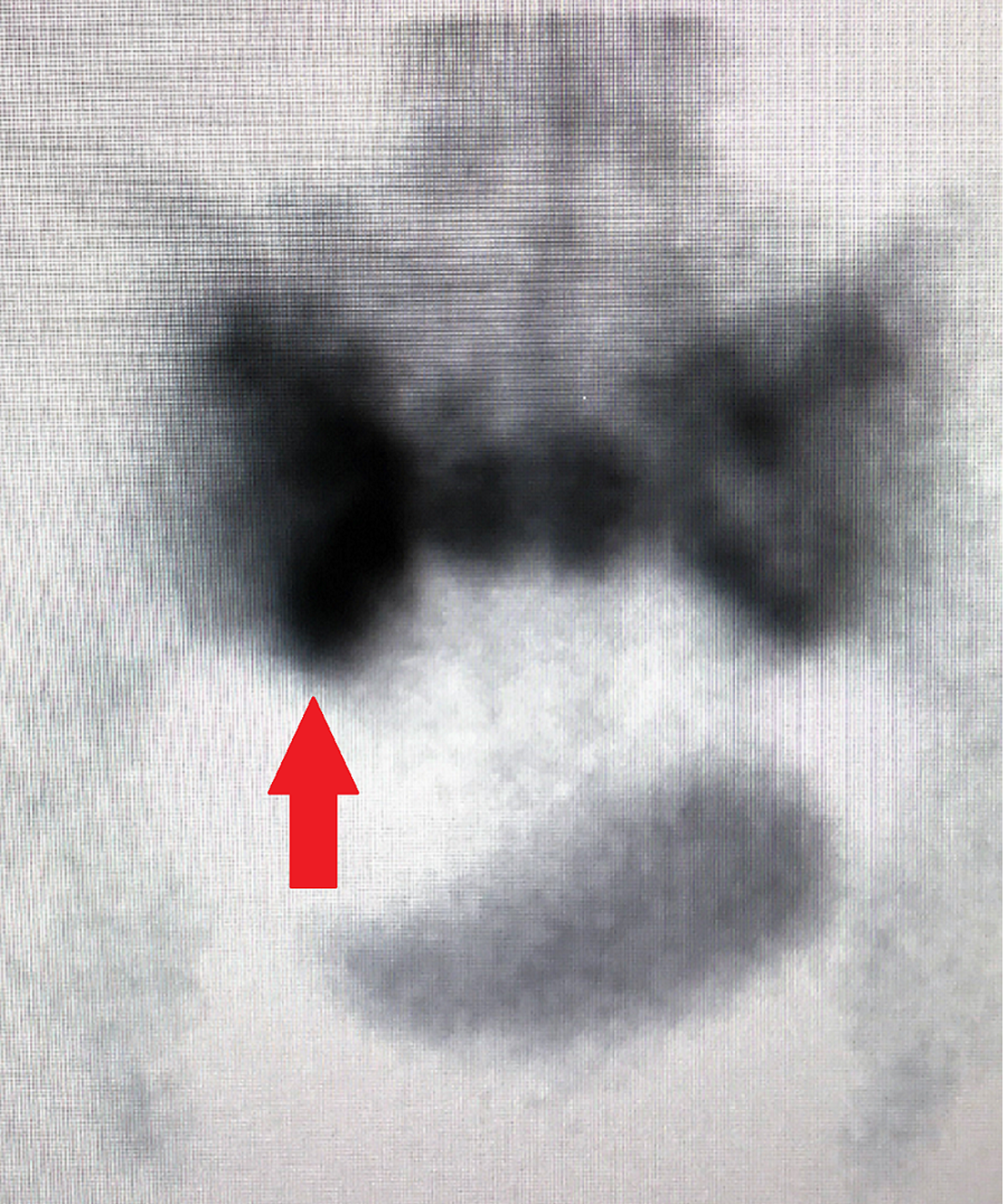 Combined Sacroplasty and Iliosacral Fixation Using Triangular Titanium ...