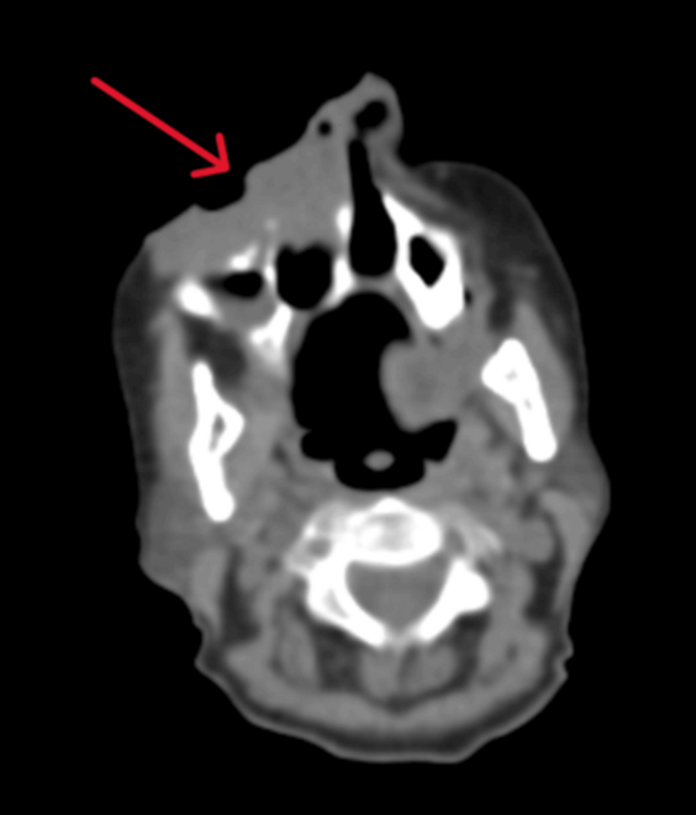 Aggressive Basal Cell Carcinoma With Rib Metastasis: An Uncommon ...