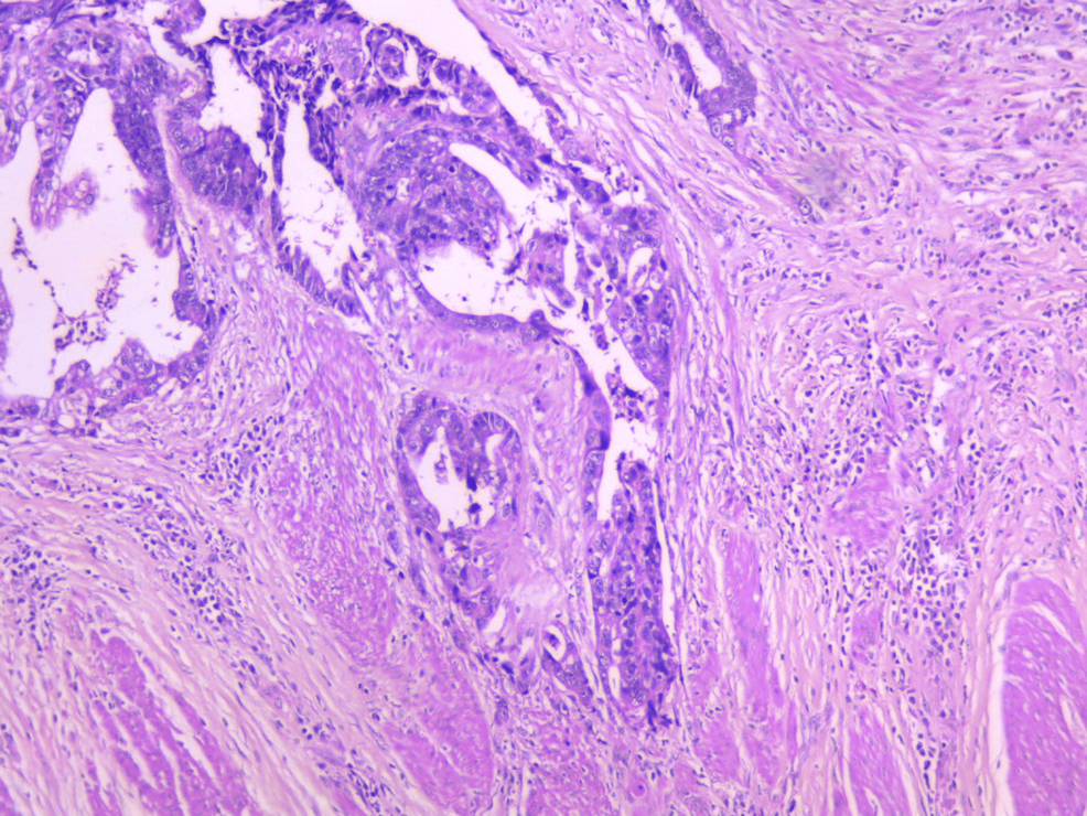 Robot-Assisted Multiquadrant Operation: Proctocolectomy and ...