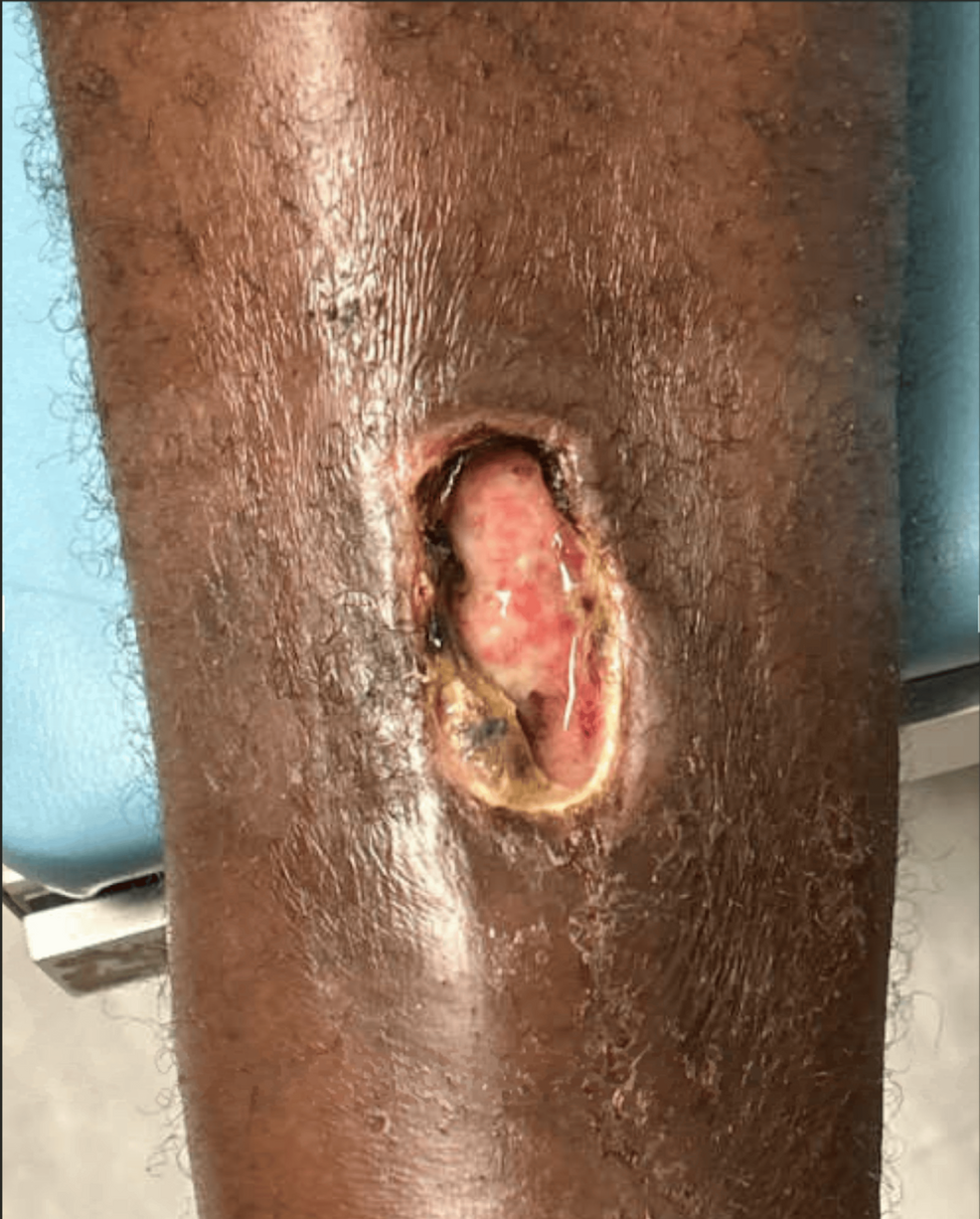 A Curious Case of Cutaneous Pathergy: Pyoderma Gangrenosum in the ...