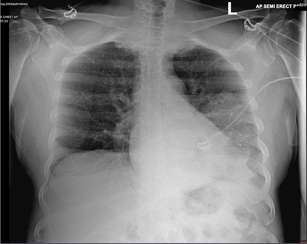 Cureus Severe Sepsis With Septic Shock As A Consequence Of A Severe 