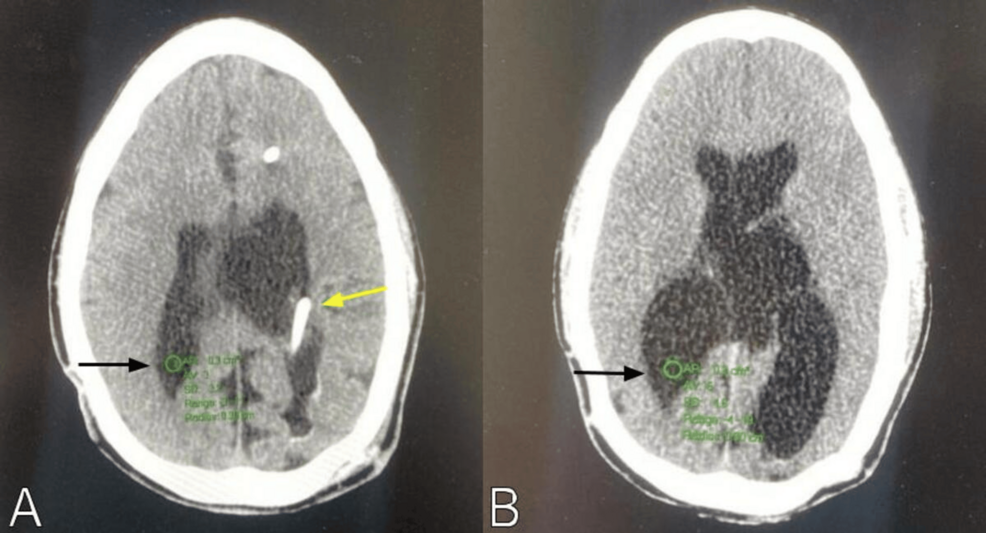 Cerebrospinal Fluid Density Measured Using Hounsfield Units on a Head ...