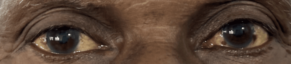 A Case of Primary Cold Agglutinin-Mediated Hemolytic Anemia ...
