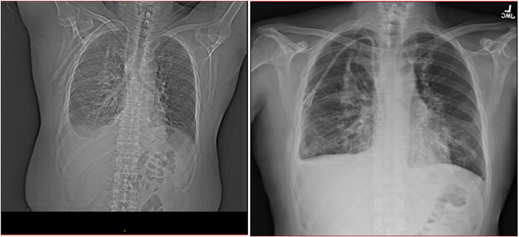Filgrastim-Associated Pneumonitis in Cancer Patient Undergoing ...