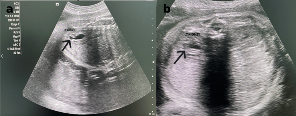 minor hydronephrosis
