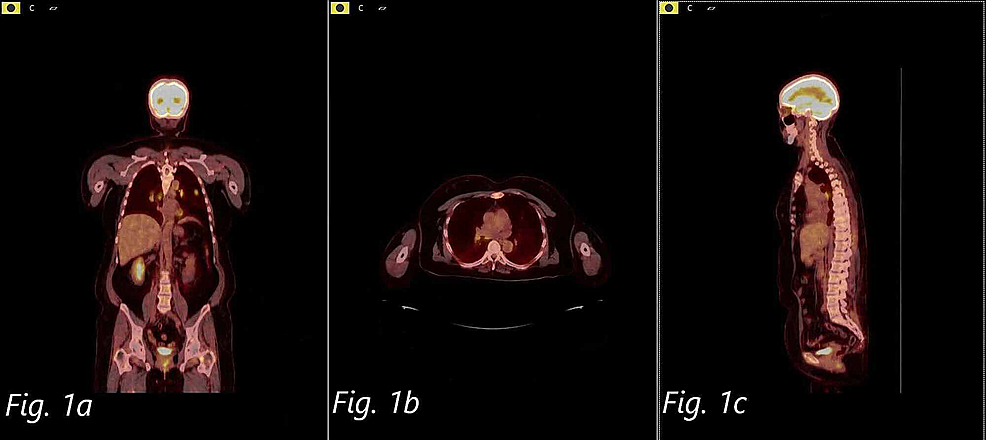 Cureus | Melanoma and the Gastrointestinal (GI) Tract: Maintaining a ...