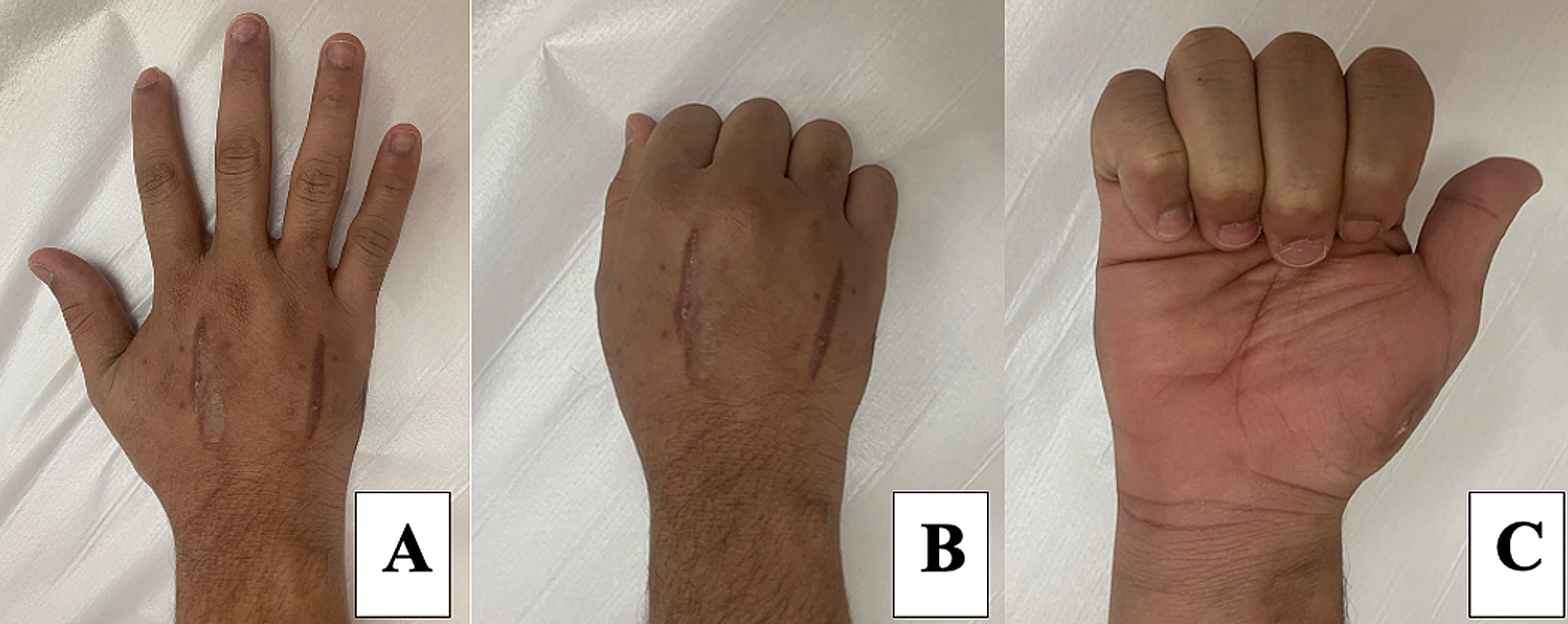 Cureus Date Palm Thorn Injury A Literature Review And A Case Study cureus-date-palm-thorn-injury-a-literature-review-and-a-case-study