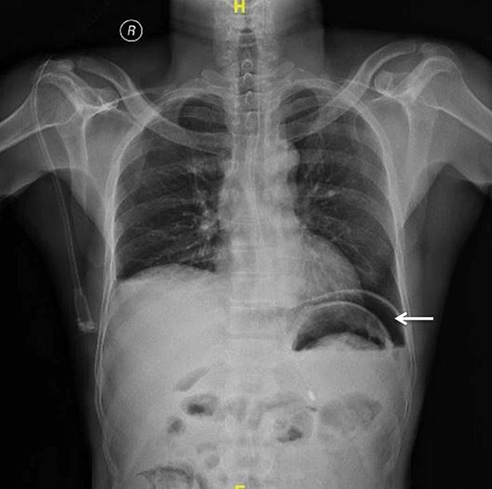 Cureus Perforation Of The Meckel s Diverticulum Following Blunt