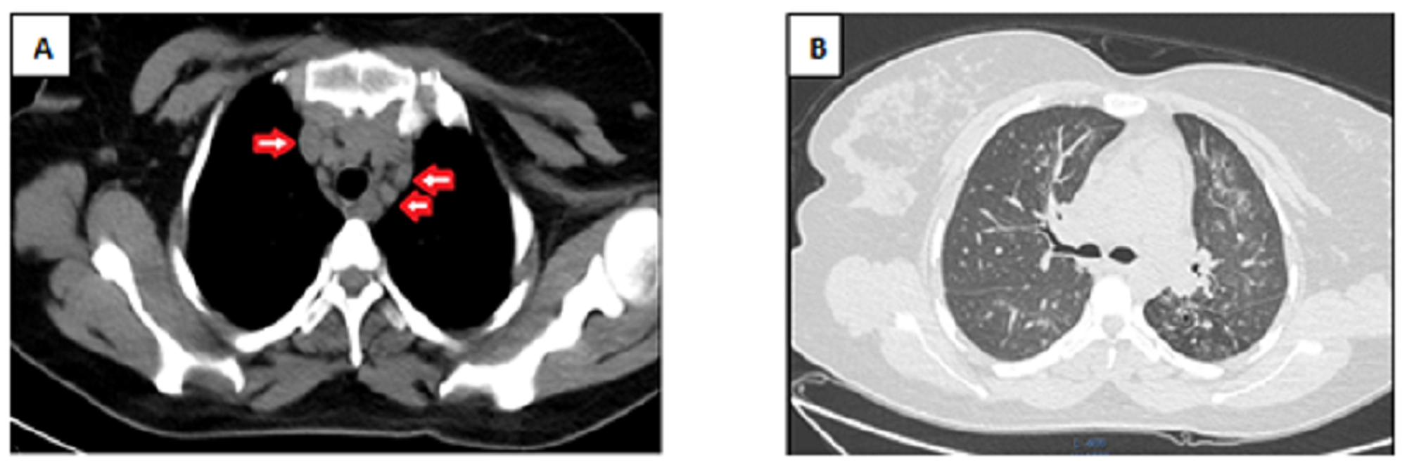 Cureus | Tuberculosis Presenting With Acute Myocarditis and Systolic ...