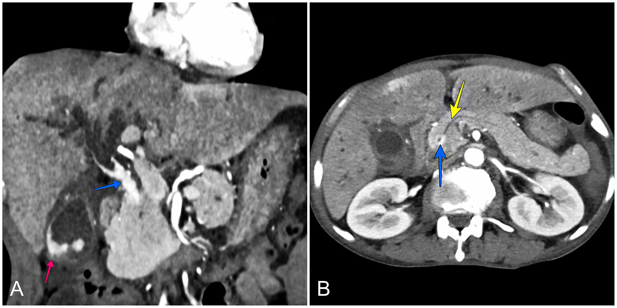 Cureus | Anomalous Pancreaticobiliary Duct Junction in an Unusual Case ...