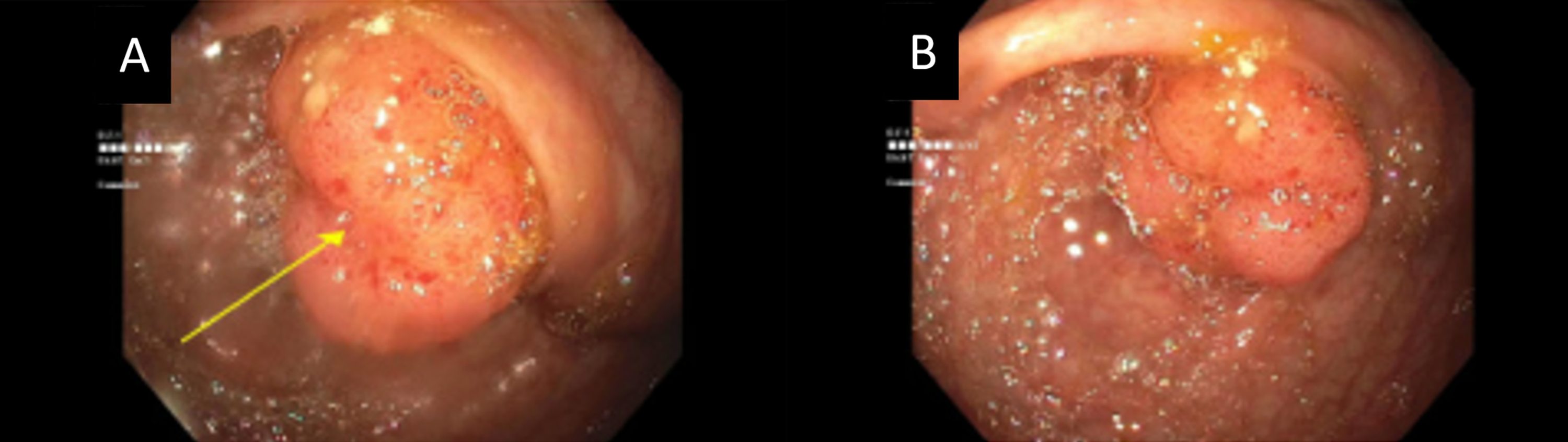 Appendiceal Adenocarcinoma Presenting As Perforated Appendicitis | Cureus