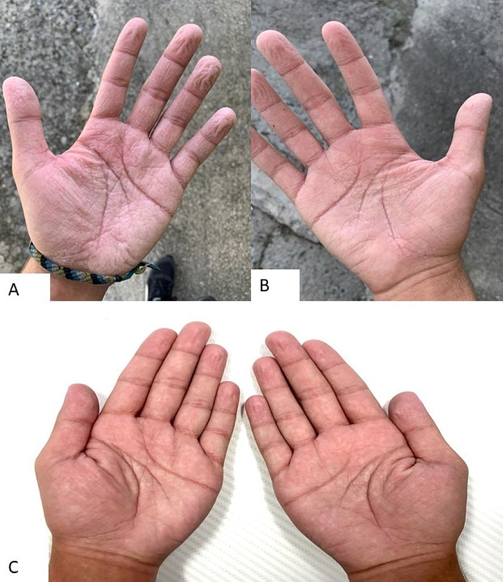 Cureus Aquagenic Wrinkling Of The Palm A Rare Diagnostic Clue Of 