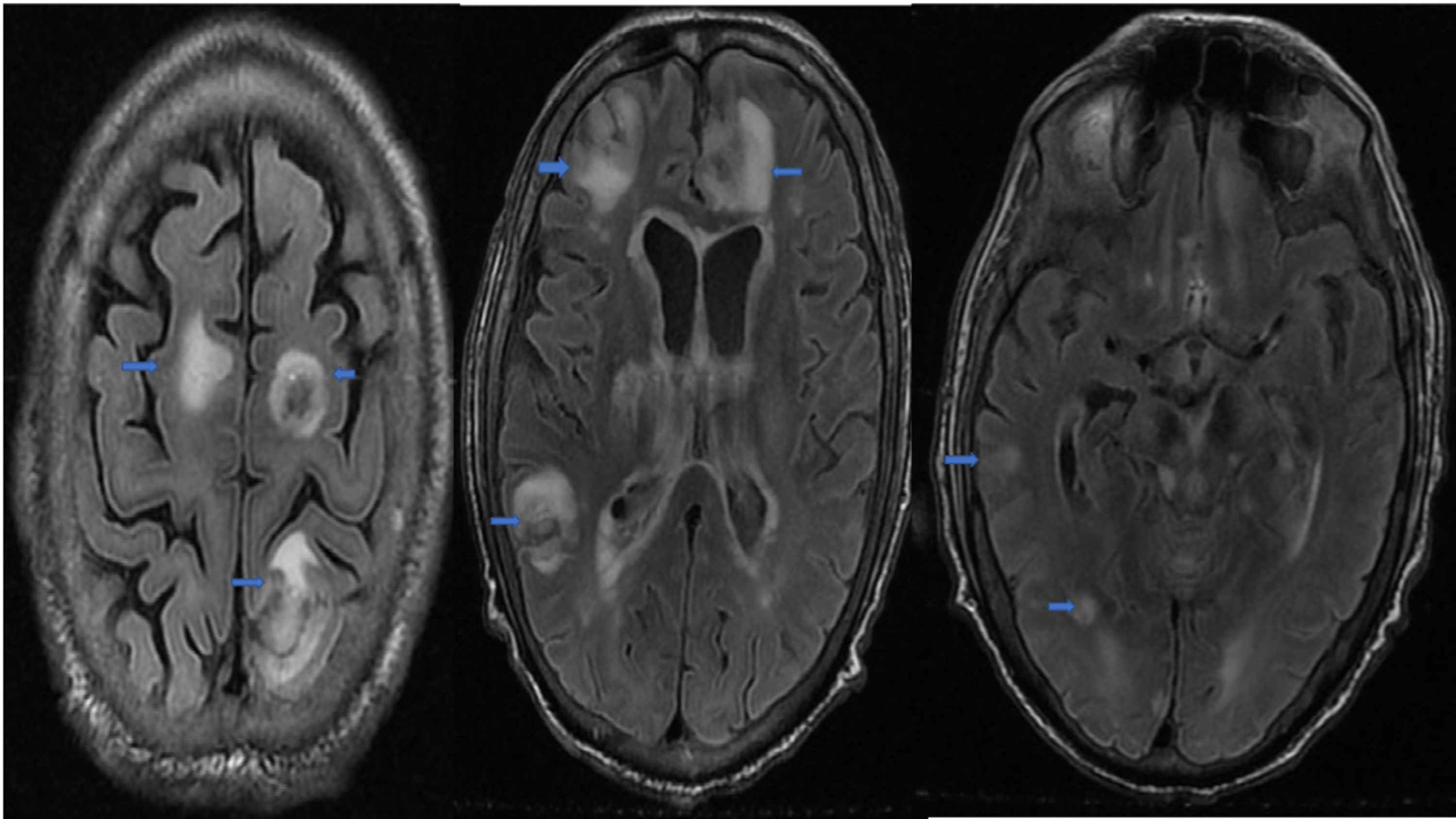 Cerebral Edema Mri