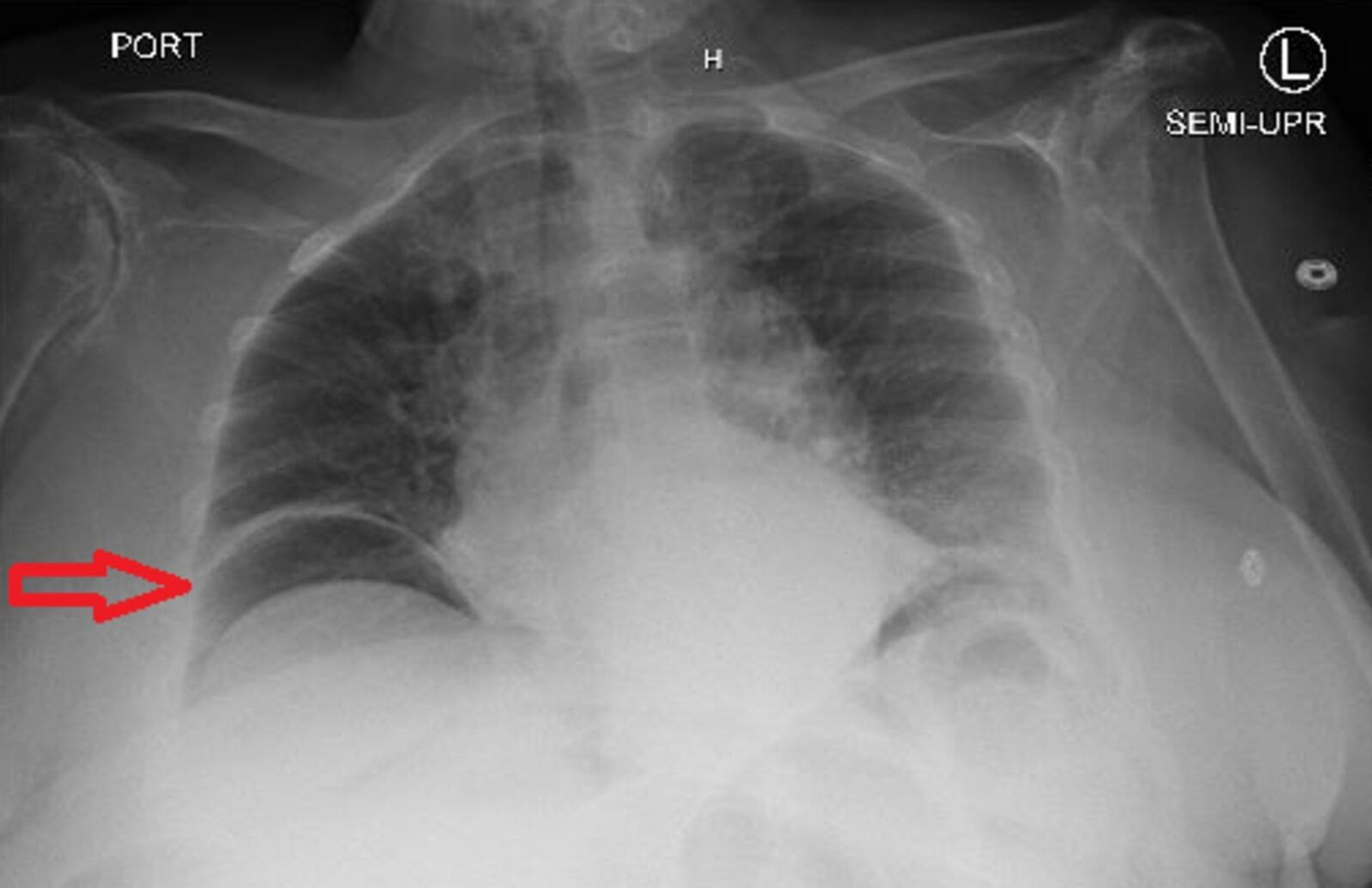 Peculiar C al Qu mico Diverticulitis Perforated Bowel Basura Patata Electo Peculiar C al Qu mico Diverticulitis Perforated Bowel Basura Patata Electo