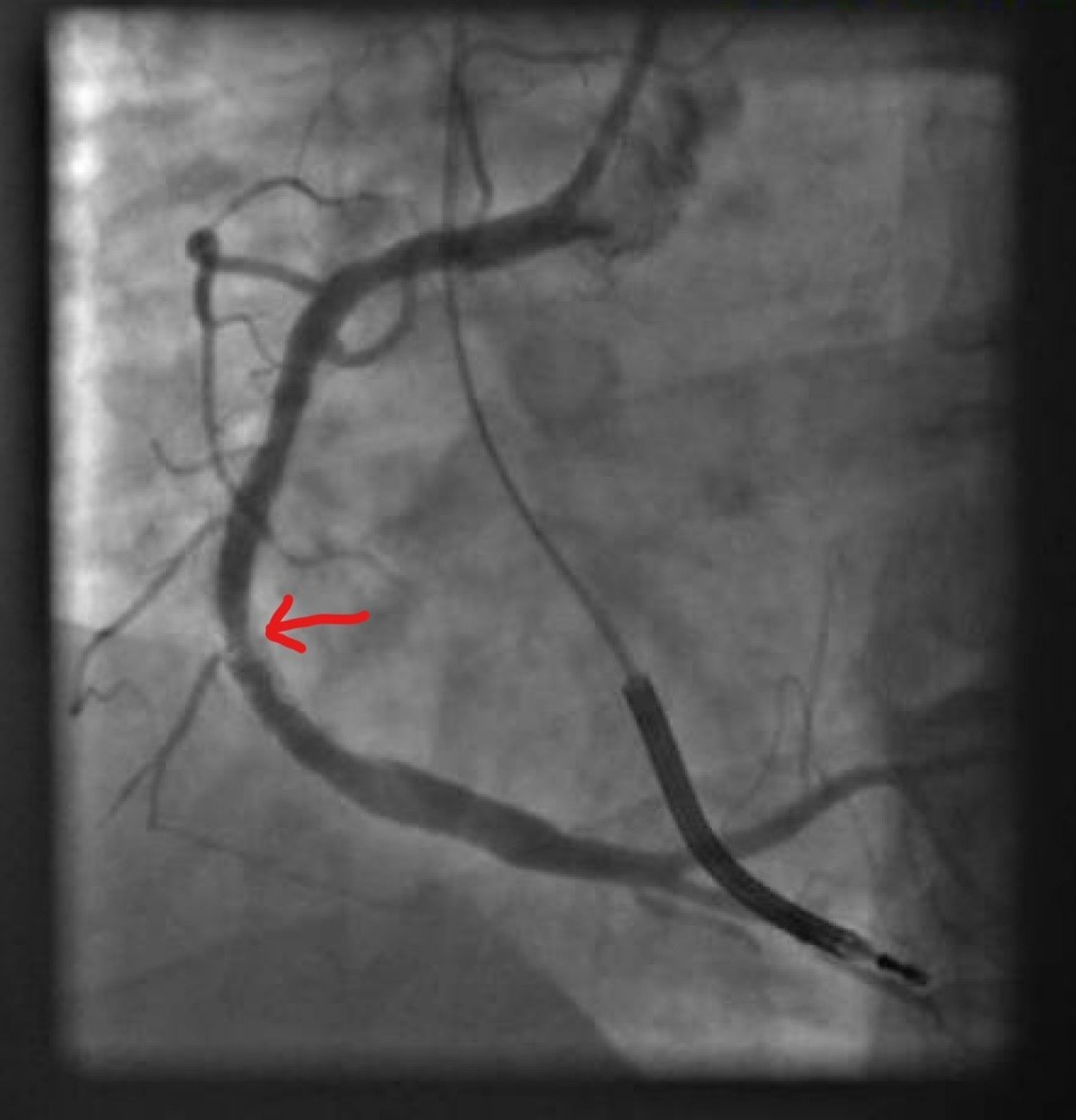 Cureus | Use of Shockwave Lithoplasty for a Patient With Recurrent Angina
