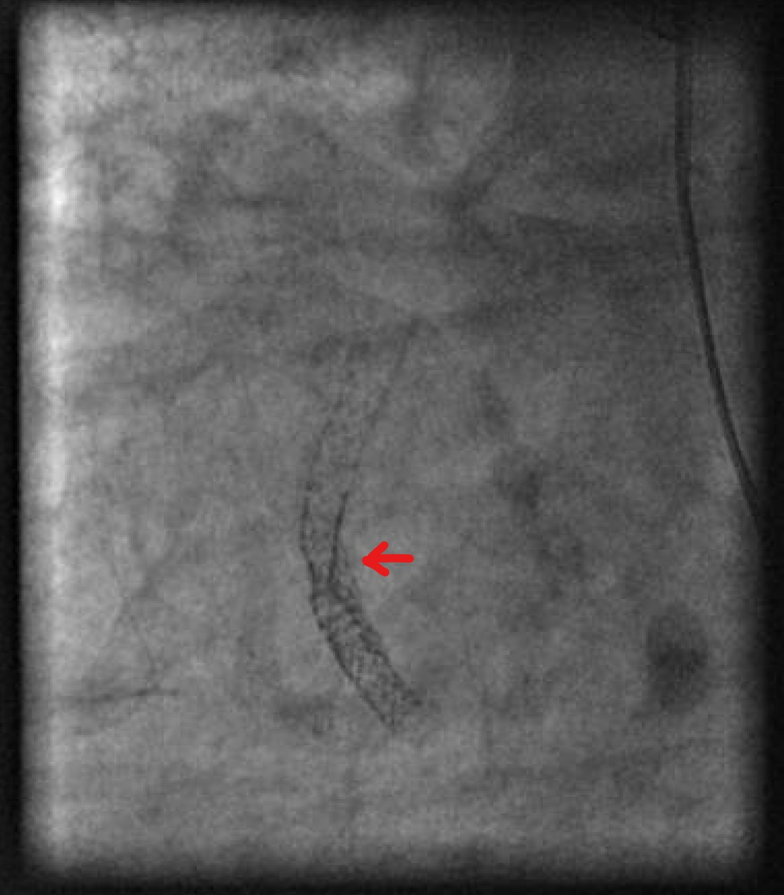 Cureus | Use of Shockwave Lithoplasty for a Patient With Recurrent Angina