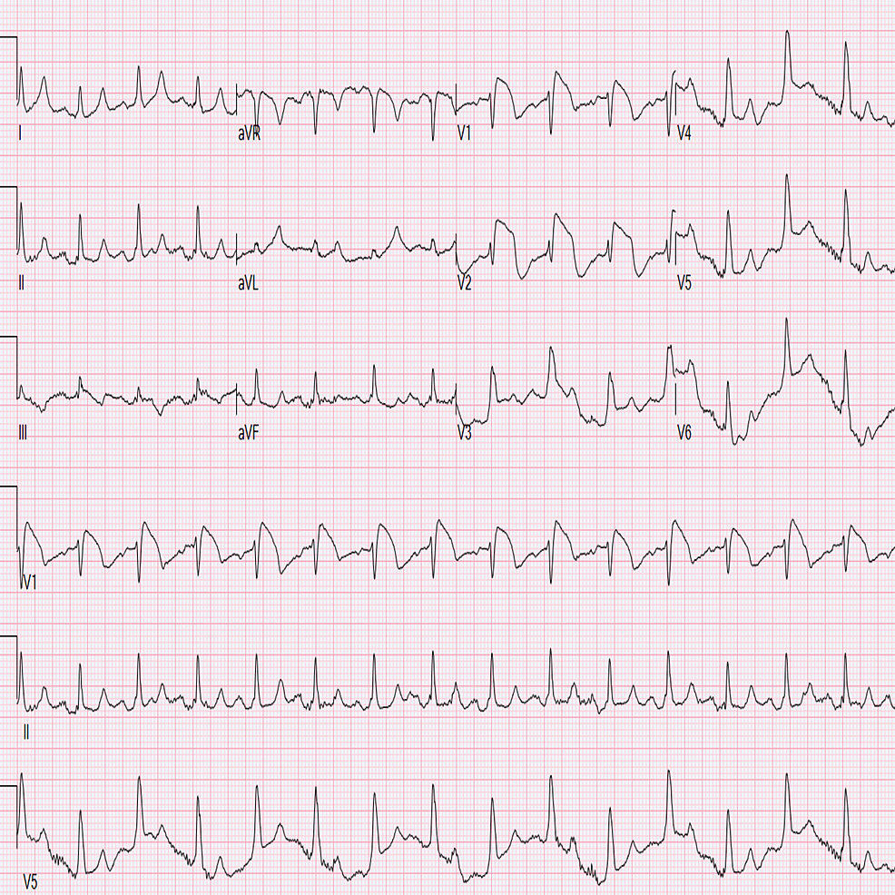Brugada Pattern Phenocopy Induced by Diabetic Ketoacidosis | Cureus