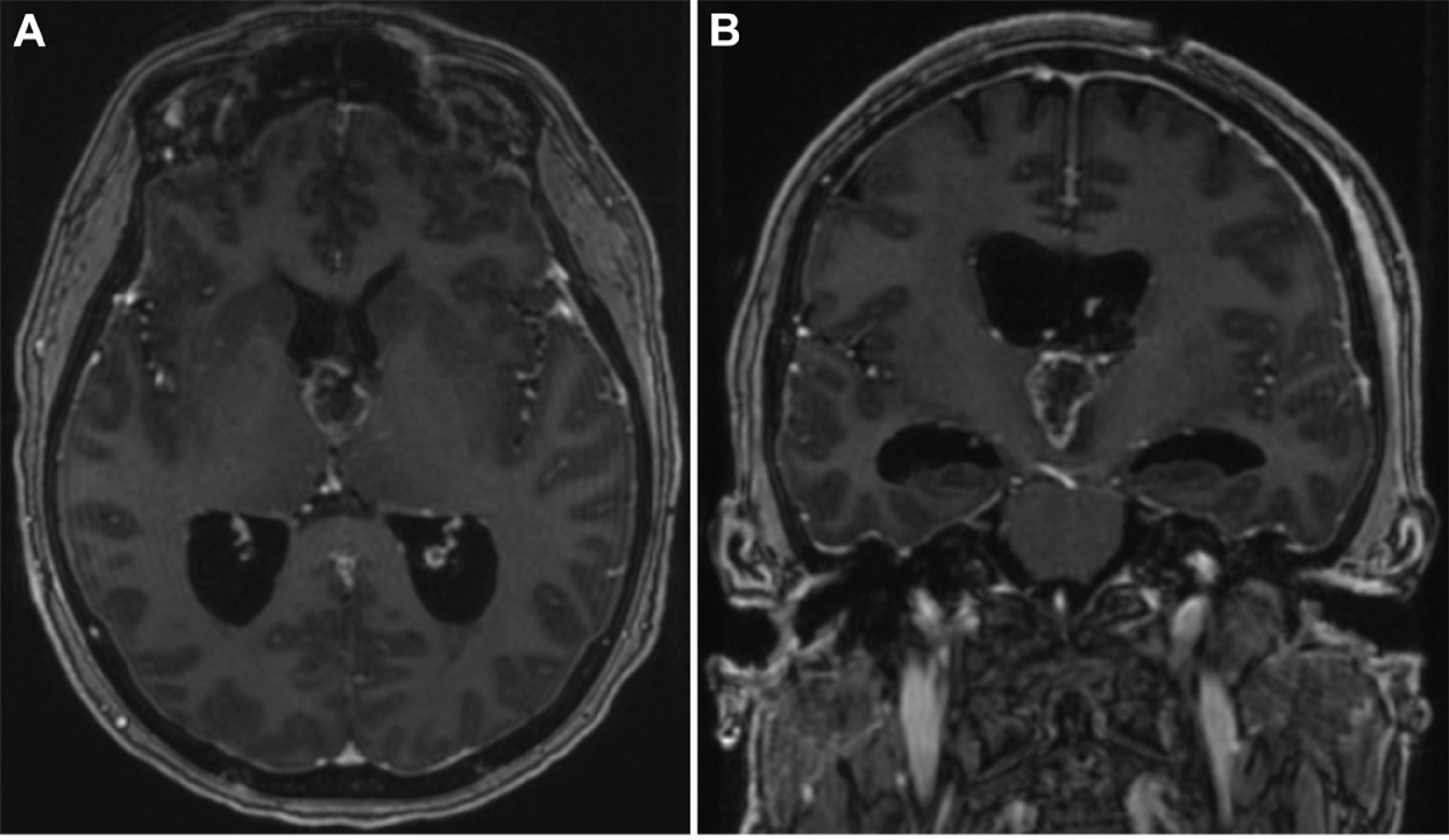 Cureus | Solitary Metastasis of Colon Adenocarcinoma Mimicking Colloid ...