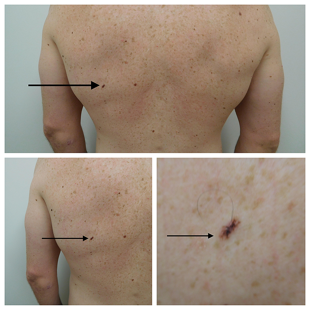 Cureus Linear Malignant Melanoma In Situ Reports And Review Of Cureus Linear Malignant Melanoma In Situ Reports And Review Of