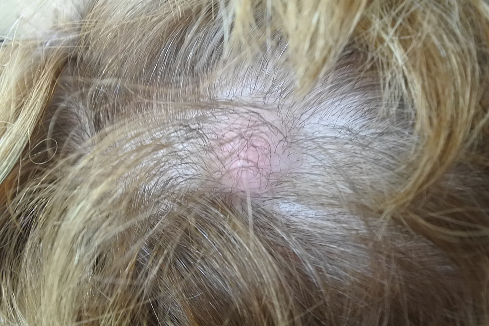 Pink Bump On Scalp My XXX Hot Girl Pink Bump On Scalp My XXX Hot Girl