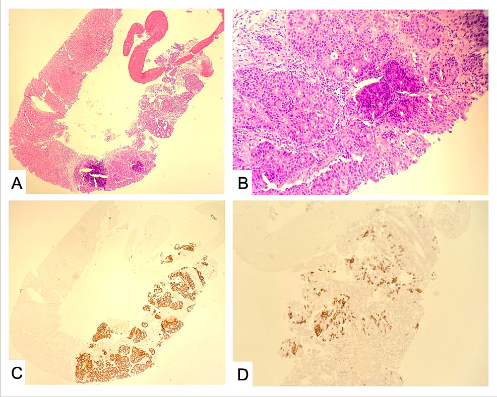 Cureus | A Rare Presentation of Appendiceal Carcinoma