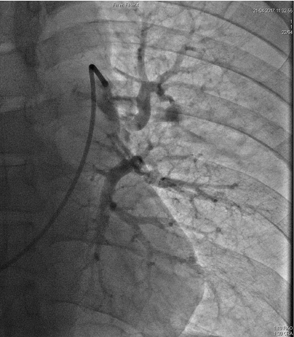 Cureus Submassive Pulmonary Embolism Treated With Catheter Directed
