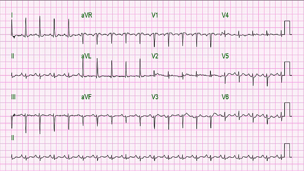 Cureus | Hypercalcemia due to Co-Occurring Metastatic Breast Cancer and ...
