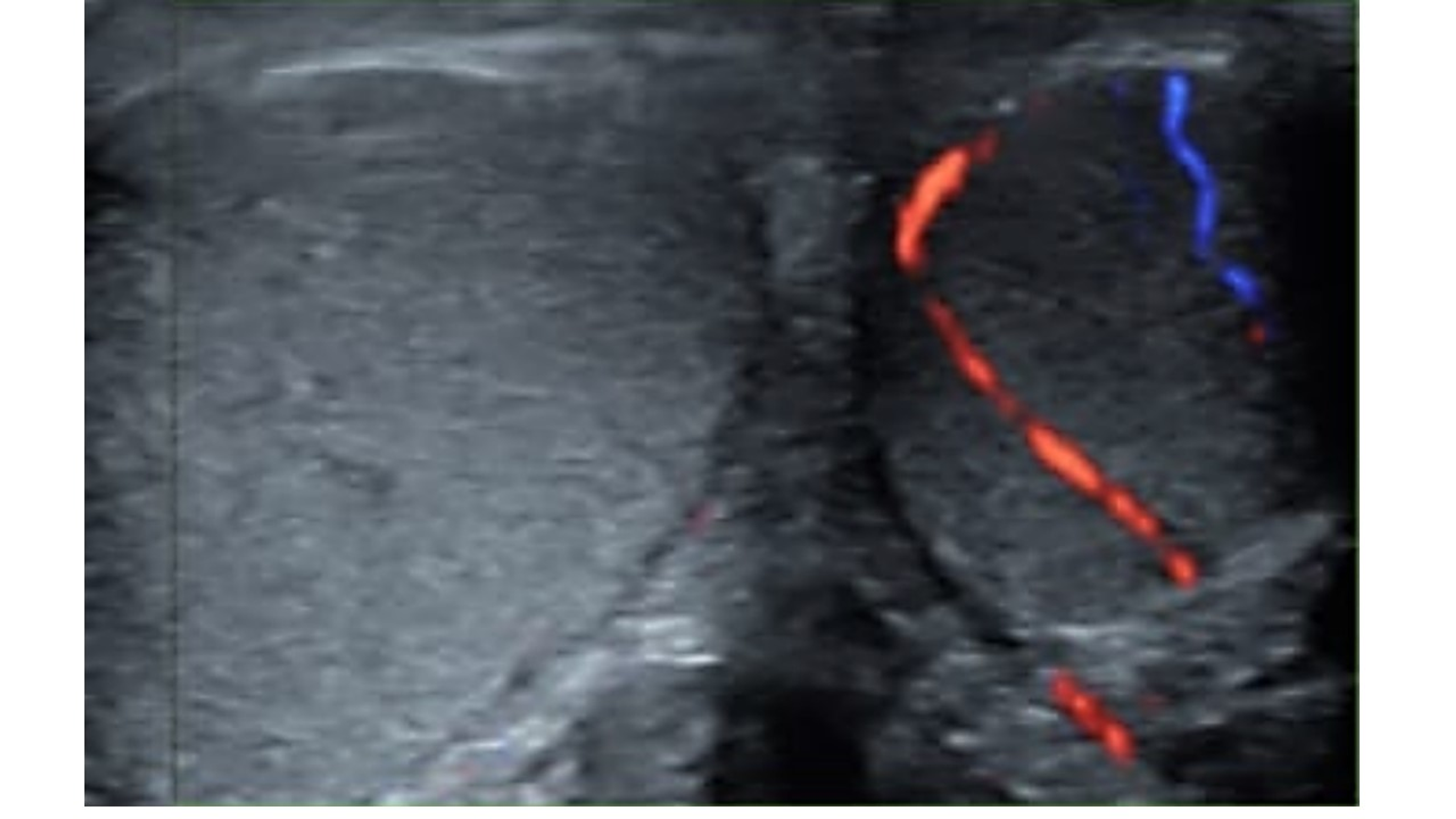 Cureus Testicular Torsion Successful Management Of A Late Diagnosed Case
