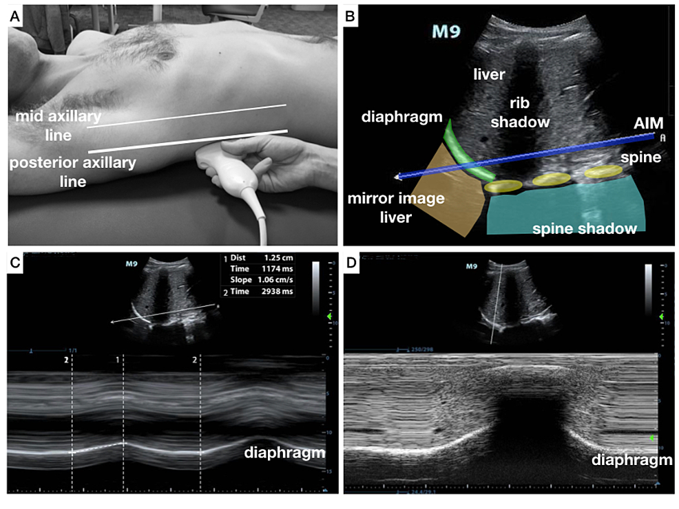Cureus The Use Of Angle Independent M Mode In The Evaluation Of