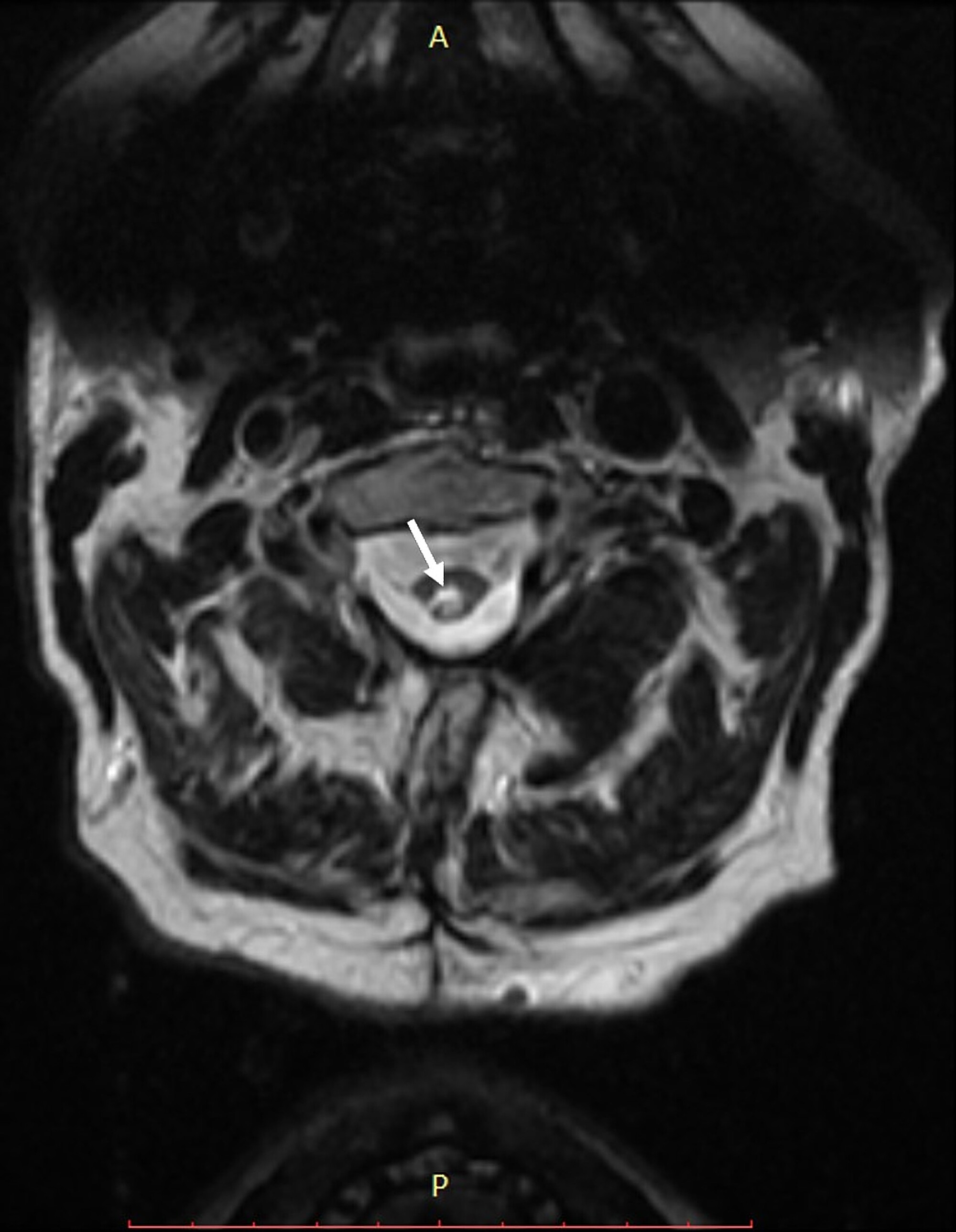 Cureus | An Atypical Clinical Presentation of Post-traumatic ...