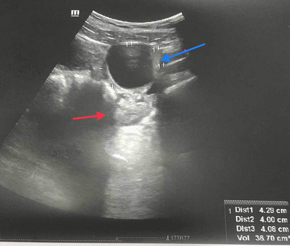 Cureus Fallopian Tube Torsion Secondary To Paraovarian Fimbrial Cyst Cureus Fallopian Tube Torsion Secondary To Paraovarian Fimbrial Cyst