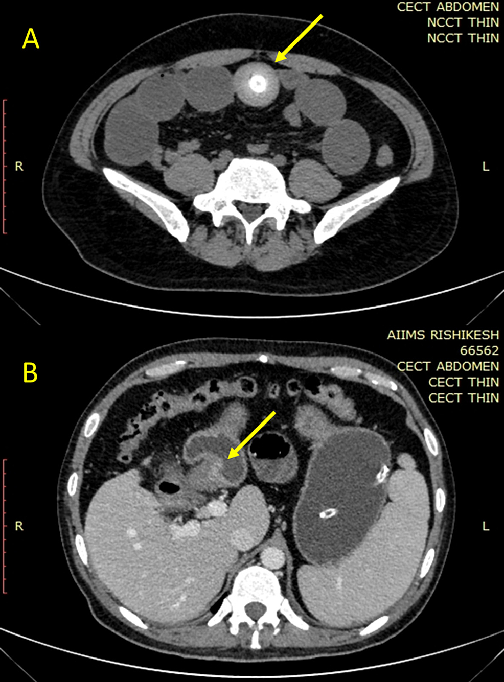 Cureus Neglected Gallstone Disease Presented As Gallstone Ileus A cureus-neglected-gallstone-disease-presented-as-gallstone-ileus-a