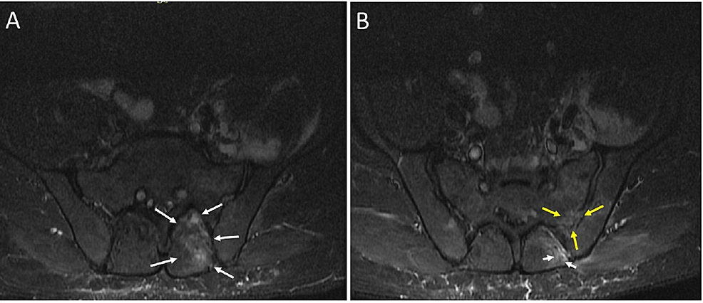Cureus | Pyomyositis Affecting the Paraspinal and Iliacus Muscles in a ...