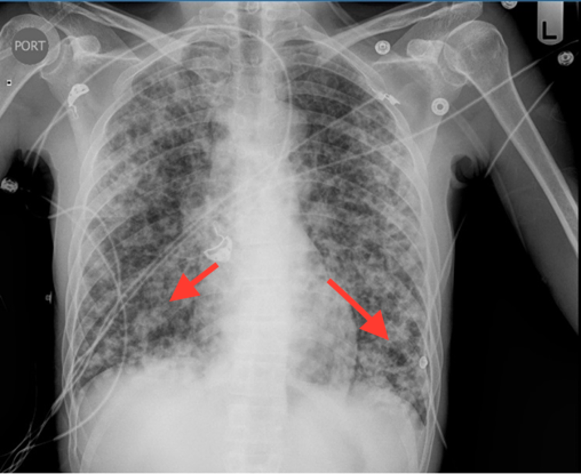 Pneumocystis Pneumonia Chest X Ray My XXX Hot Girl