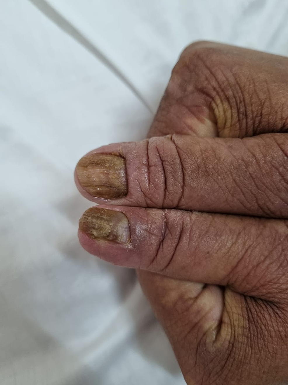 Cureus Nail Mycosis Fungoides A New Case