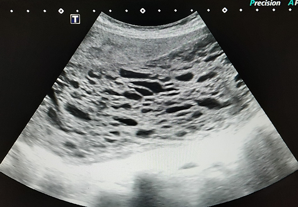 Cureus Rare Case Of A Young Female With Co existent Hydatidiform Mole Cureus Rare Case Of A Young Female With Co existent Hydatidiform Mole
