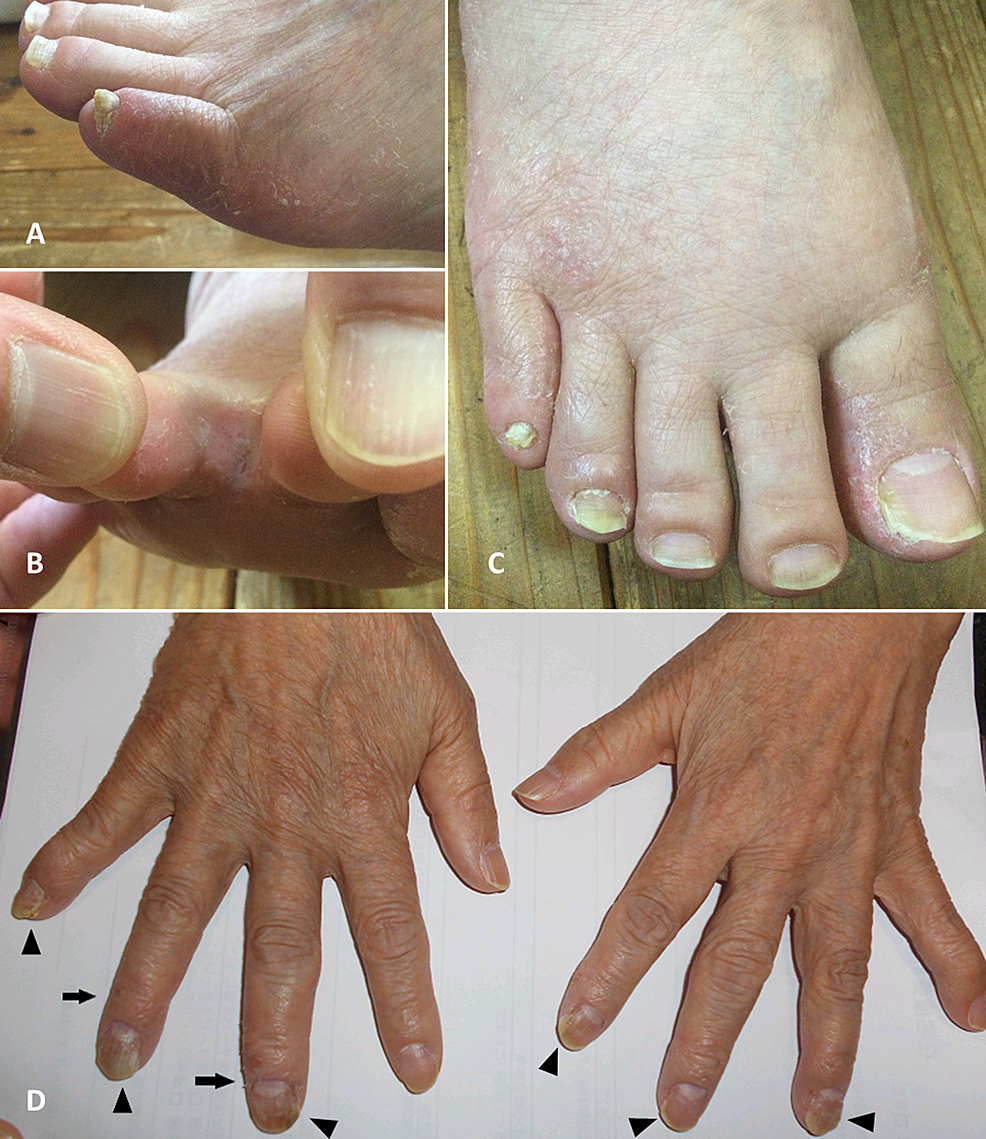 Cureus Two Feet One Hand Syndrome