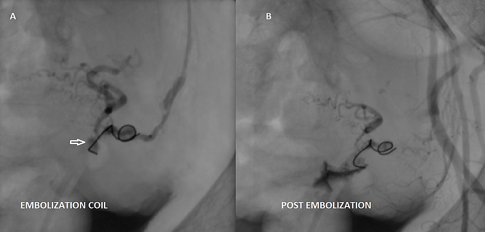 Cureus Role Of Uterine Artery Embolization In Pseudoaneurysm Of