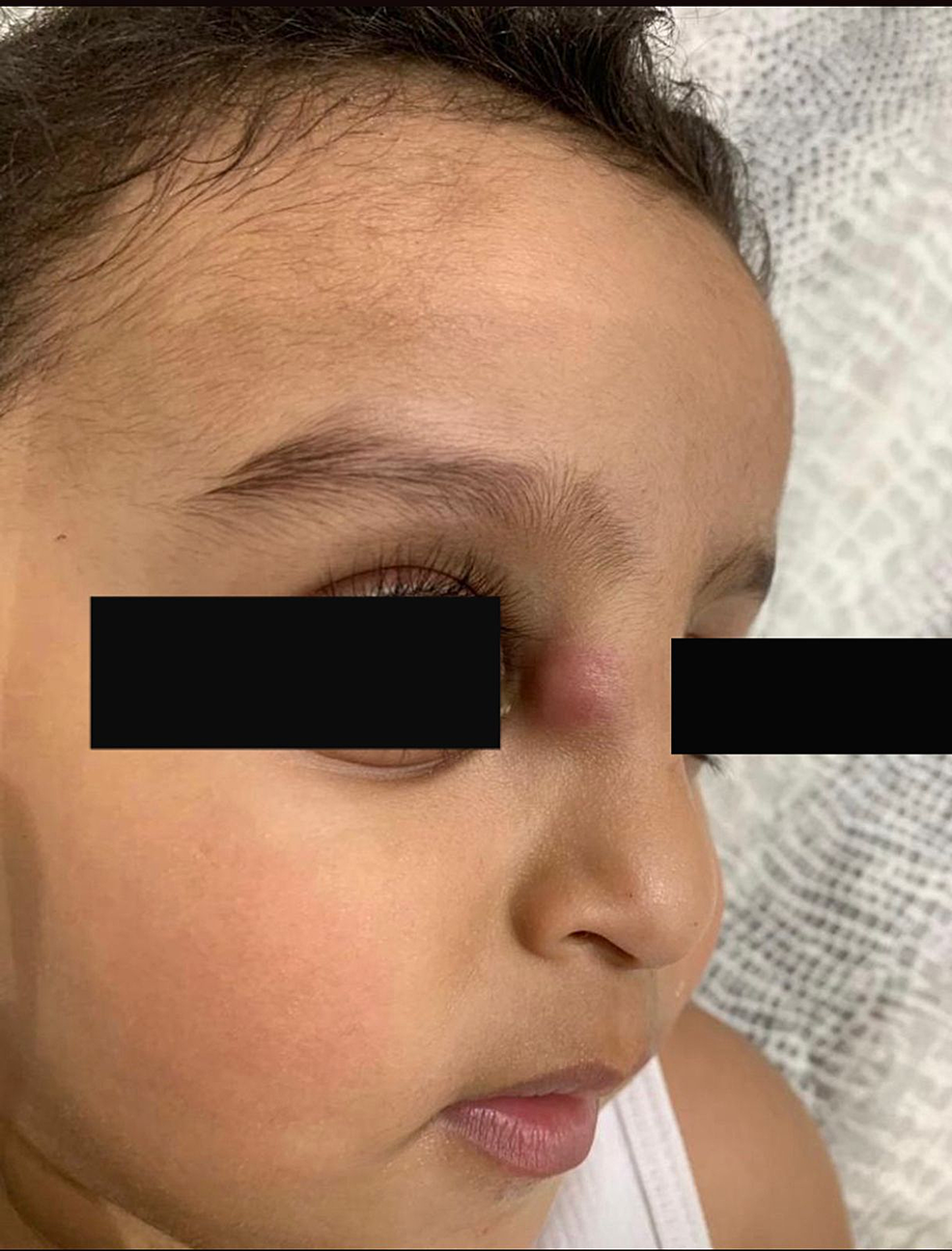 Cureus Nasal Dermoid Cyst A Case Report Cureus Nasal Dermoid Cyst A Case Report