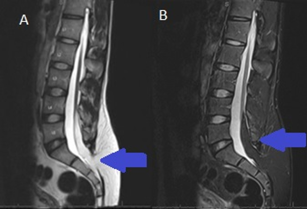Cureus Tethered Cord Syndrome Associated With Lumbar Cureus Tethered Cord Syndrome Associated With Lumbar